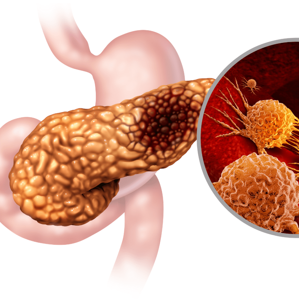 Encapsulated Cell Therapy May Help Treat Type 1 Diabetes - Diabetes ...